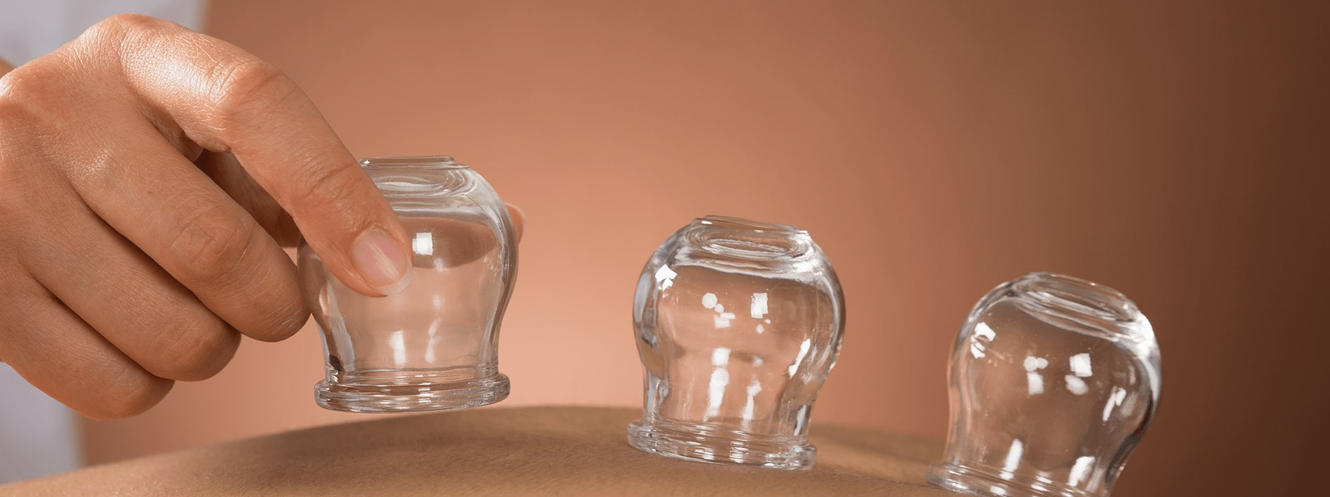 Cupping Therapy - Pacific Bay Recovery